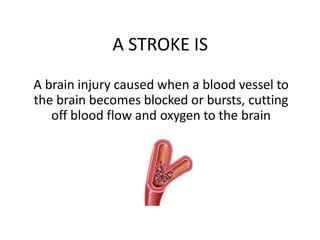 CVA- Ischemic Stroke Case Study | PPTX