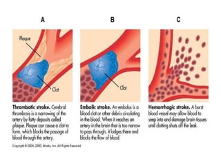 CVA- Ischemic Stroke Case Study | PPTX