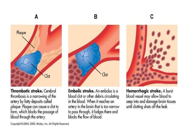 CVA- Ischemic Stroke Case Study | PPTX | Brain and Nervous System Disorders | Diseases and ...