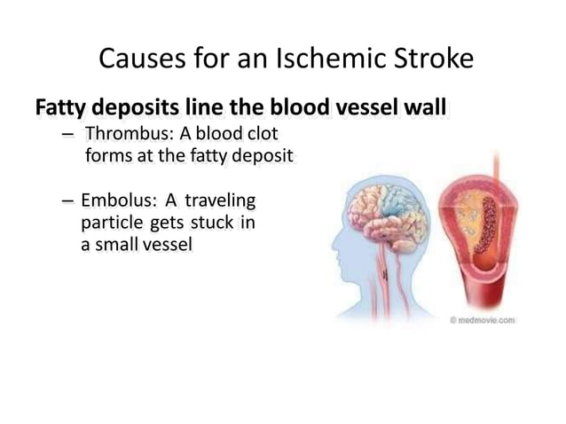 CVA- Ischemic Stroke Case Study | PPTX | Brain and Nervous System Disorders | Diseases and ...