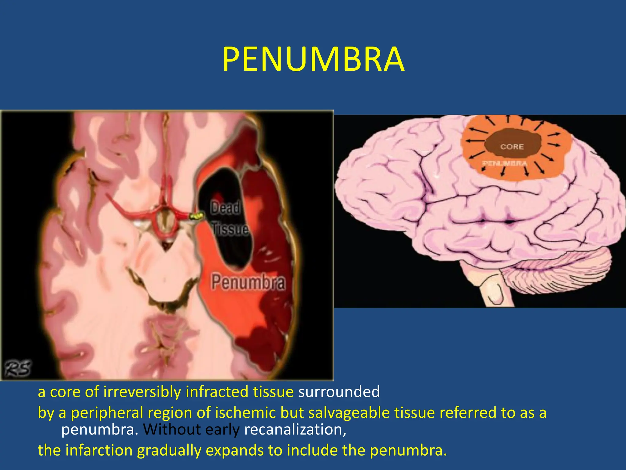 stroke FOAM Acute central nervous system injury with abrupt onset | PDF