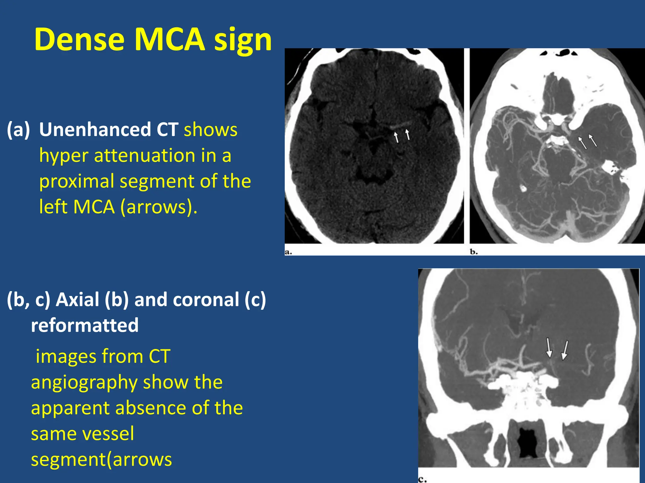 stroke FOAM Acute central nervous system injury with abrupt onset | PDF