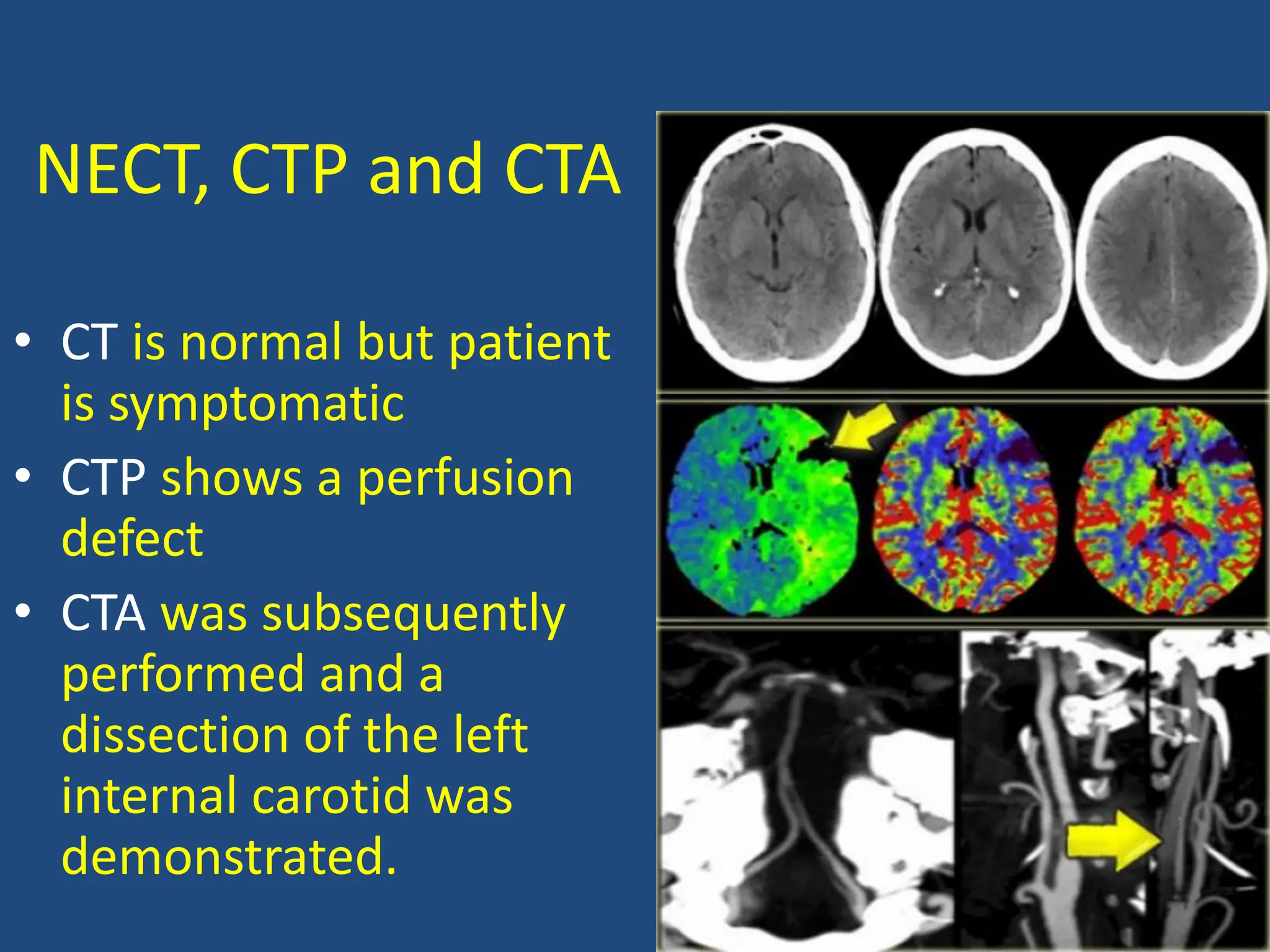 stroke FOAM Acute central nervous system injury with abrupt onset | PDF