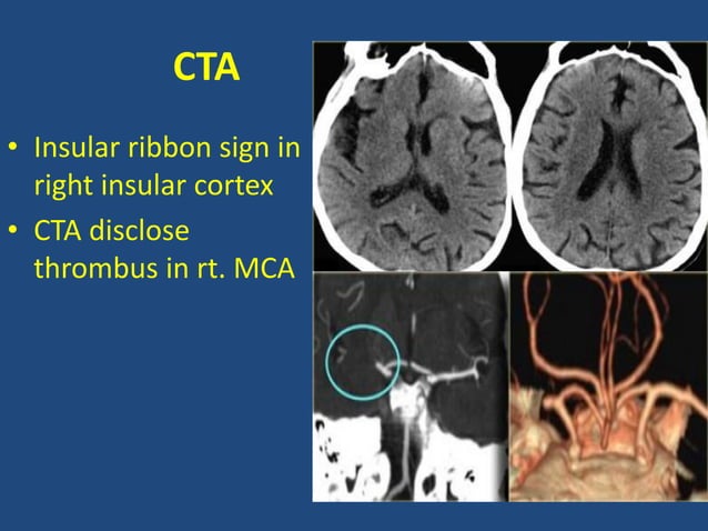 stroke FOAM Acute central nervous system injury with abrupt onset | PDF