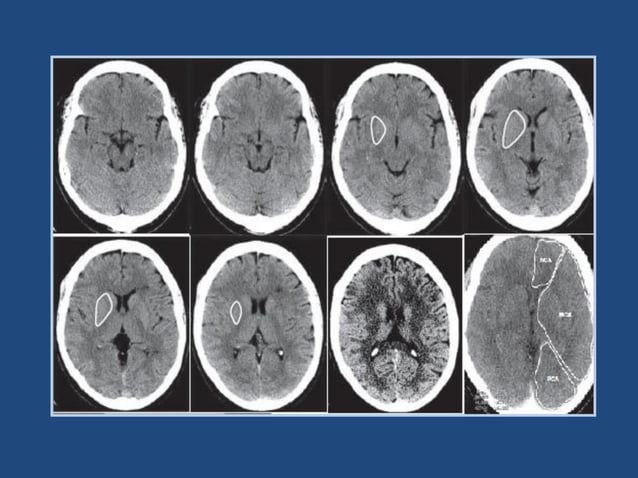 stroke FOAM Acute central nervous system injury with abrupt onset | PDF