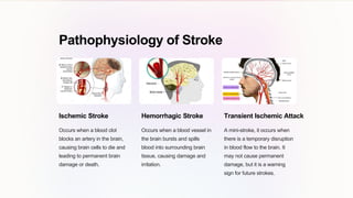 Stroke | PPTX