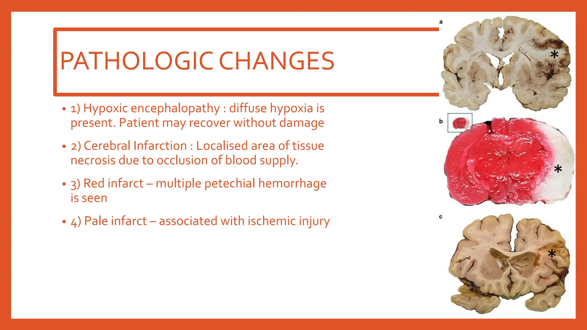 STROKE AND ITS TYPES - PATHOLOGY LECTURE | PPTX