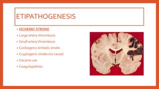 STROKE AND ITS TYPES - PATHOLOGY LECTURE | PPTX