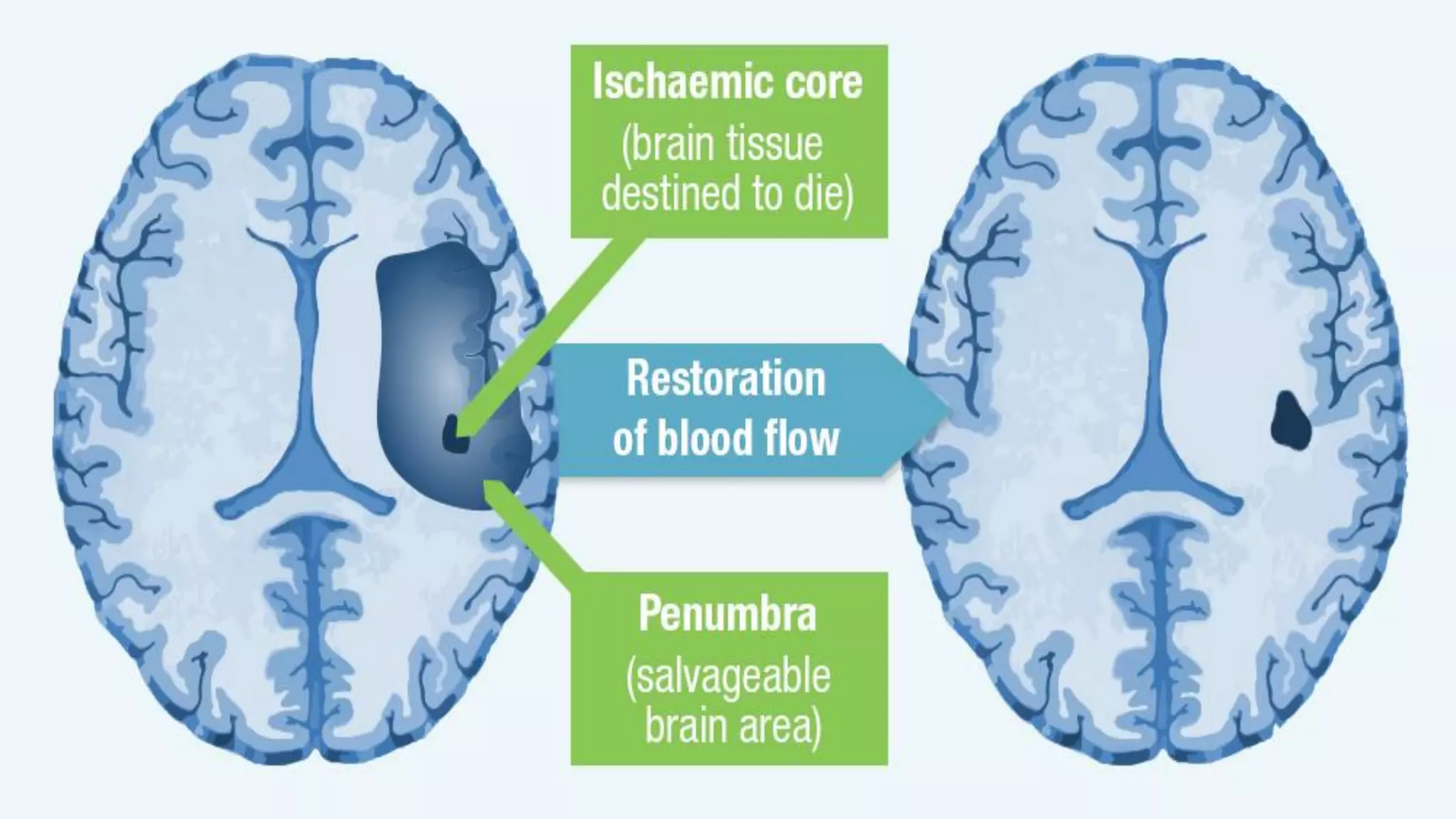 Stroke - Cerebrovascular Accident (CVA) | PDF