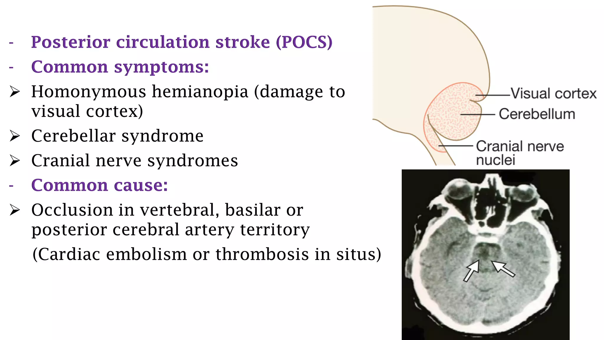 Stroke - Cerebrovascular Accident (CVA) | PDF
