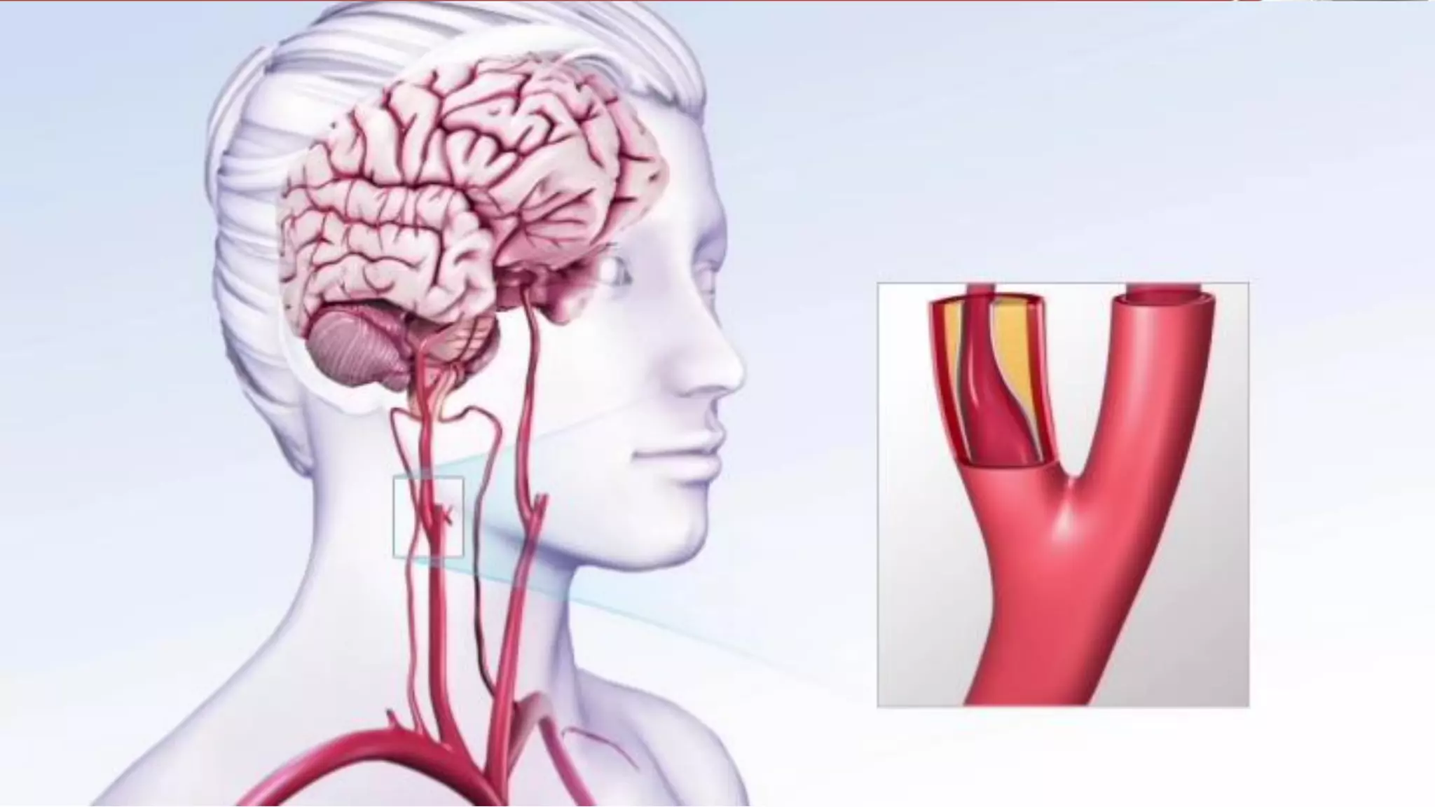 Stroke - Cerebrovascular Accident (CVA) | PDF