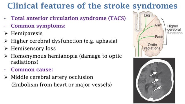 Stroke - Cerebrovascular Accident (CVA) | PDF | Heart and ...