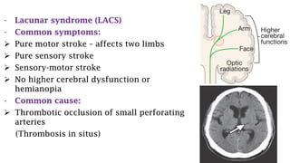 Stroke - Cerebrovascular Accident (CVA) | PDF