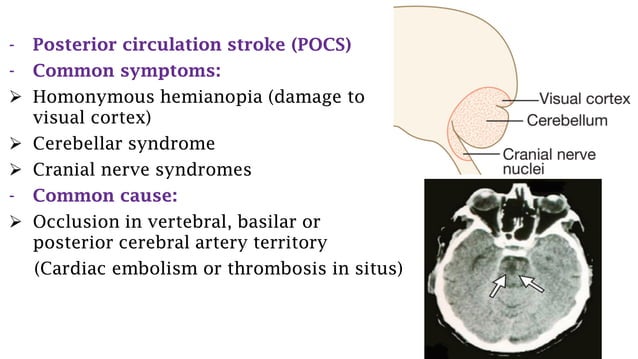 Stroke - Cerebrovascular Accident (CVA) | PDF | Heart and ...
