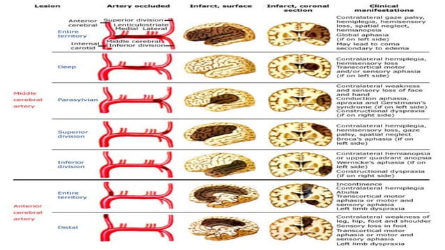 Stroke - Cerebrovascular Accident (CVA) | PDF | Heart and ...