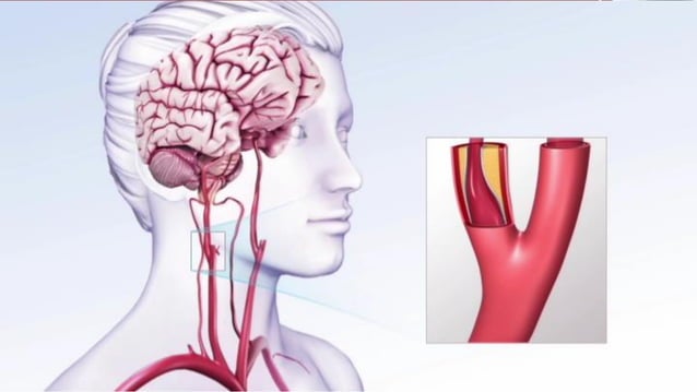 Stroke - Cerebrovascular Accident (CVA) | PDF | Heart and ...