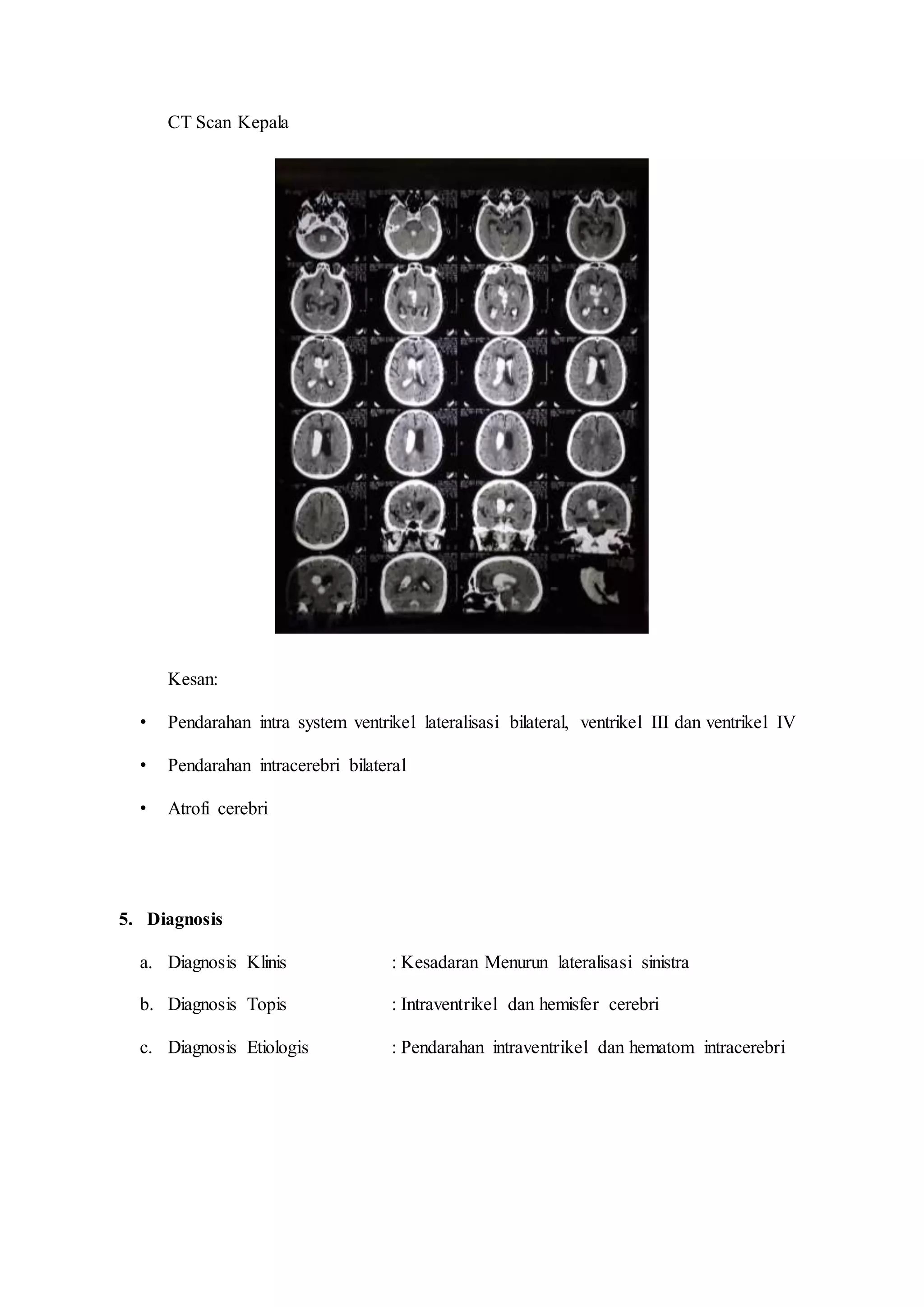 Laporan Kasus Stroke Hemoragik | DOCX
