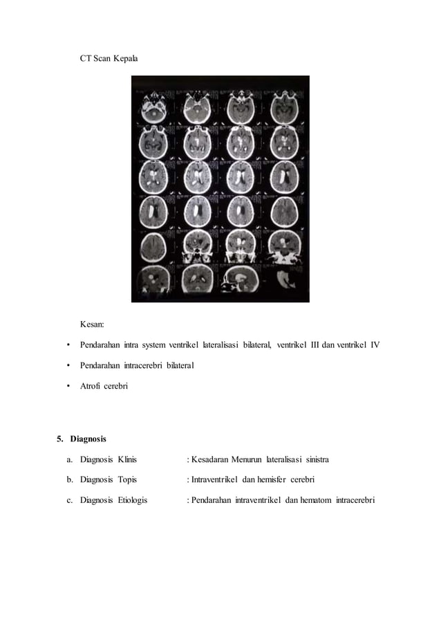Laporan Kasus Stroke Hemoragik | DOCX