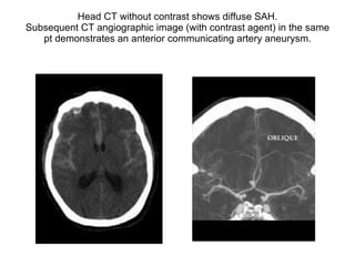 Stroke imaging | PPT