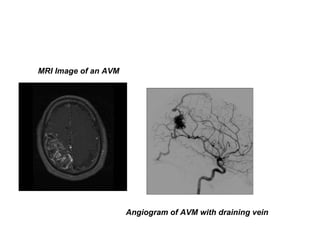 Stroke imaging | PPT