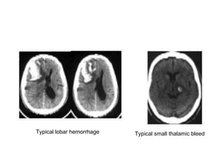 Stroke imaging | PPT