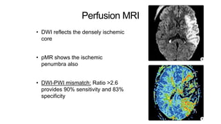 Imaging in acute ischemic stroke cases.pptx