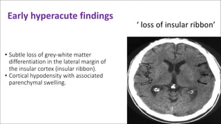 Stroke imaging | PDF
