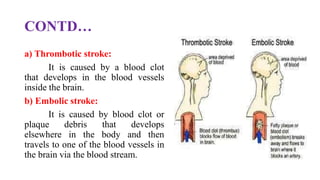 stroke in ducks.pptx