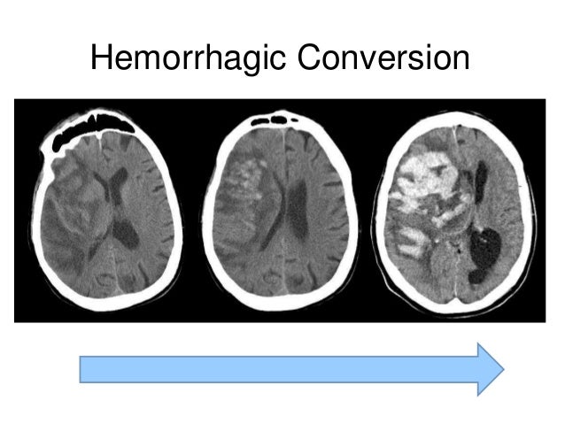 Stroke Overview - EM Orientation