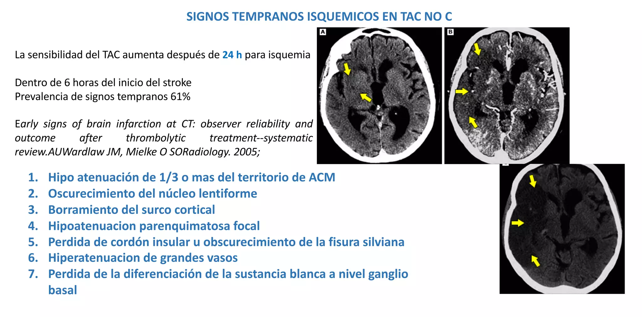 STROKE ENFERMEDAD CEREBROVASCULAR | PDF