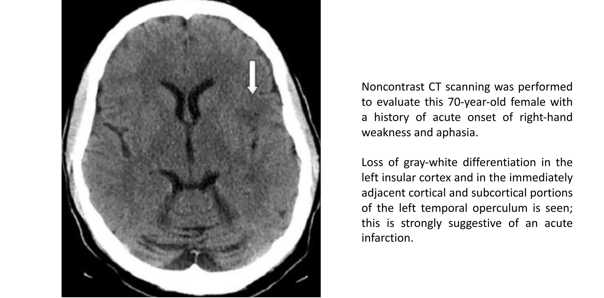 STROKE ENFERMEDAD CEREBROVASCULAR | PDF