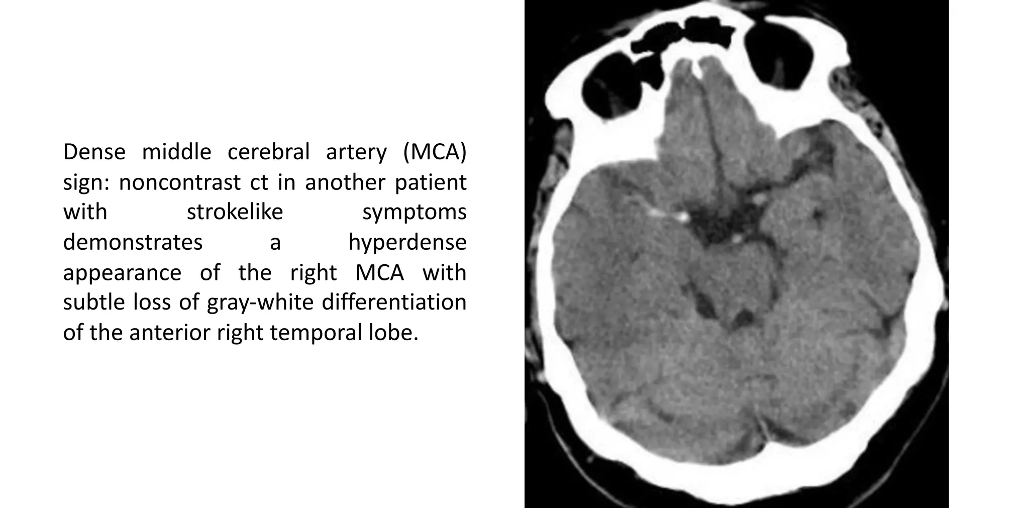 STROKE ENFERMEDAD CEREBROVASCULAR | PDF