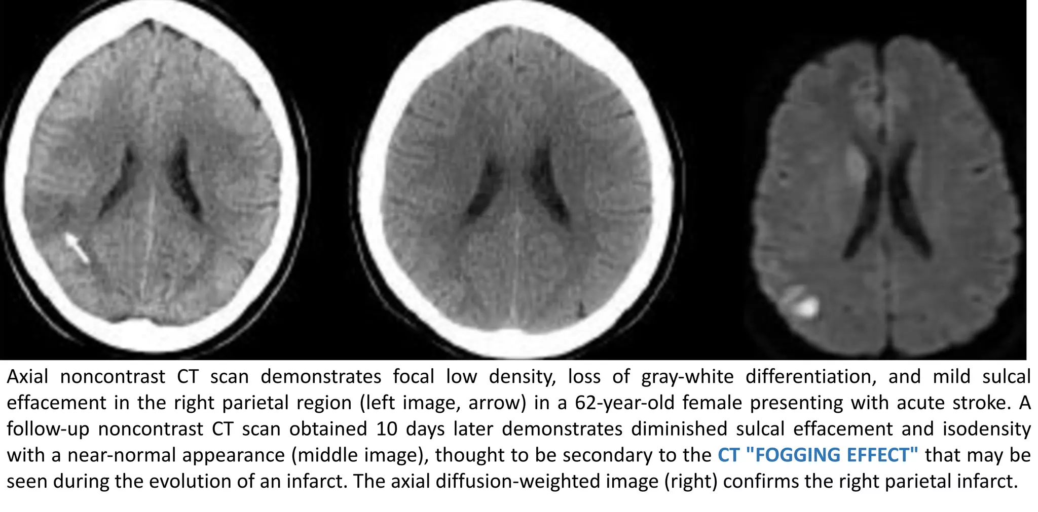 STROKE ENFERMEDAD CEREBROVASCULAR | PDF