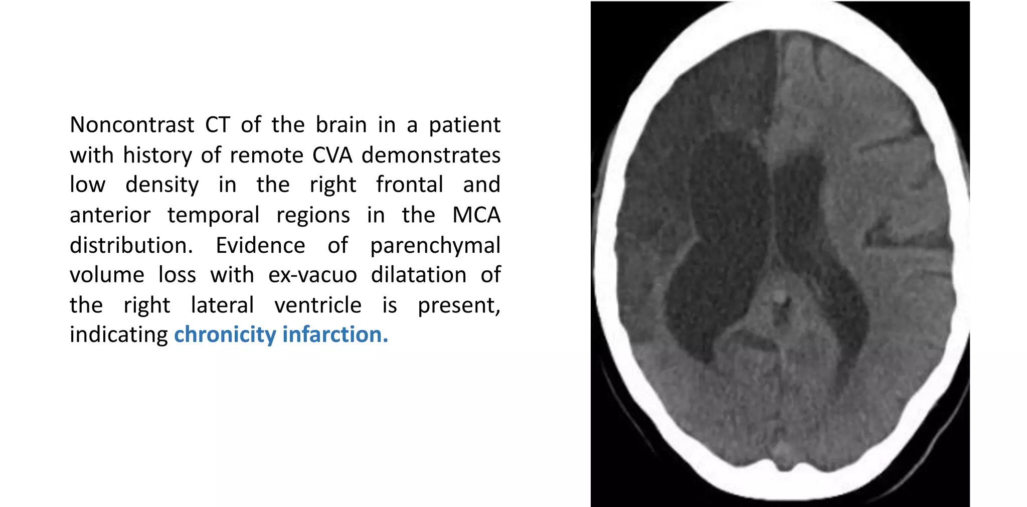 STROKE ENFERMEDAD CEREBROVASCULAR | PDF