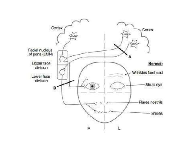 Stroke localization | PPTX | Blood Disorders | Diseases and Conditions