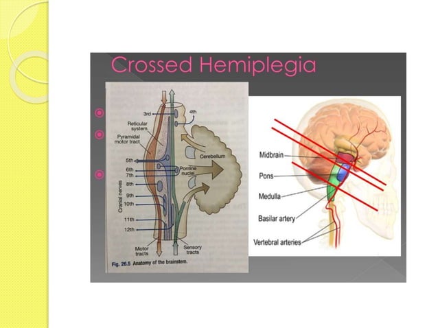 Stroke localization by Dr. Md. firoz | PPTX | Brain and Nervous System ...