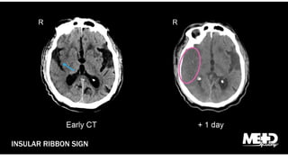 Acute ischemic stroke | PPTX