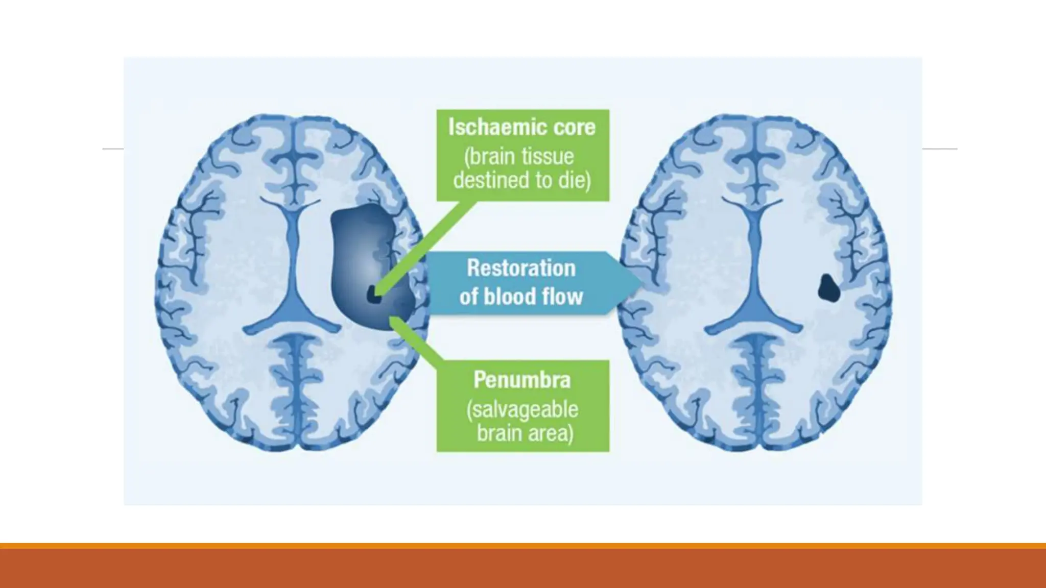 Stroke Microteaching.pptx