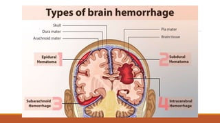 Stroke Microteaching.pptx