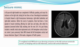 Stroke mimics | PPTX