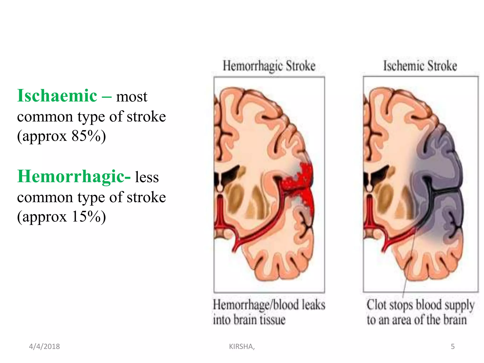 Stroke and management | PPTX