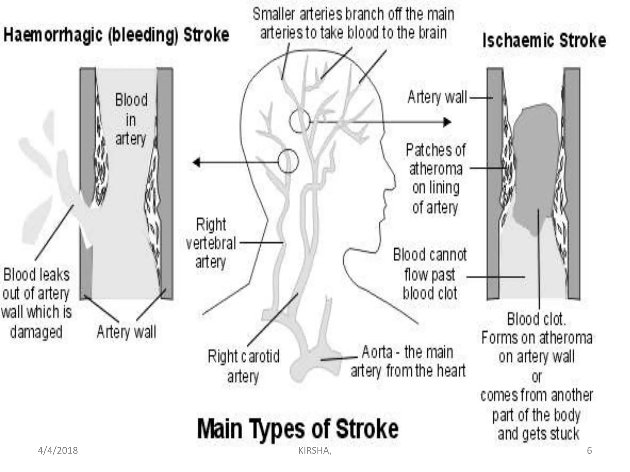 Stroke and management | PPTX