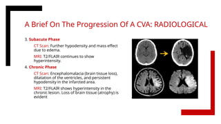 Stroke (Natural History, Progression).pptx
