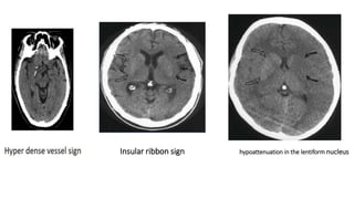 An Overview on Stroke & management | PPT