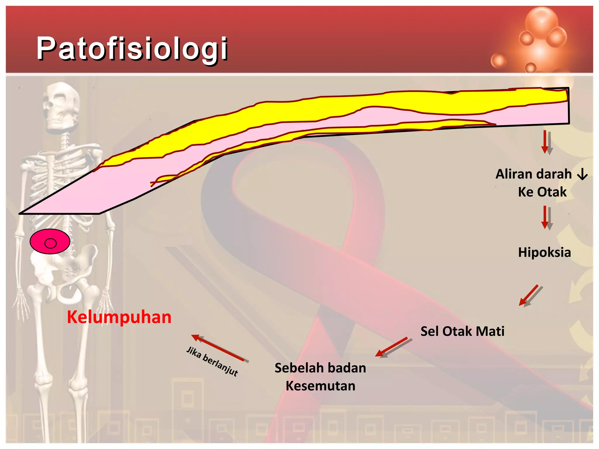 Stroke non hemoragik | PPT