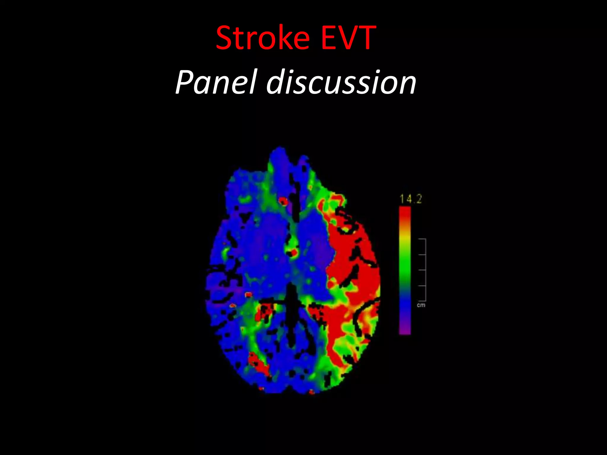 Stroke EVT- A Discussion | PPTX