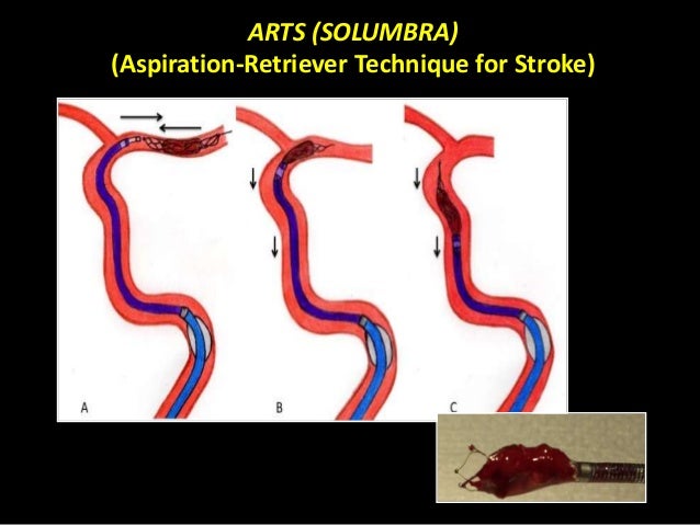 Stroke EVT- A Discussion