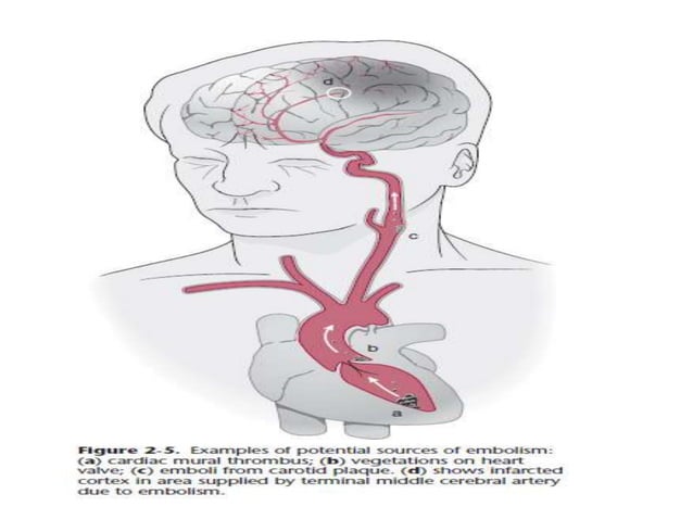 Stroke patho physiology | PPTX | Brain and Nervous System Disorders ...