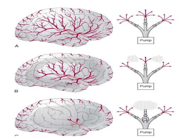Stroke patho physiology | PPTX | Brain and Nervous System Disorders ...