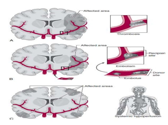 Stroke patho physiology | PPTX | Brain and Nervous System Disorders ...